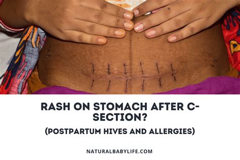 Itchy Rash On Breast Postpartum At Palmer Ellerbee Blog