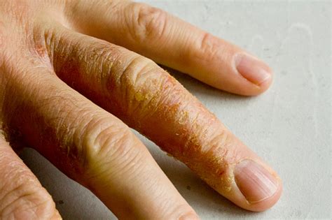 사람의 손과 손가락에 습진 피부염의 클로즈업 피부 박리 손의 Desquamation 회색 현대 배경 손 피부염 습진 손가락 문제