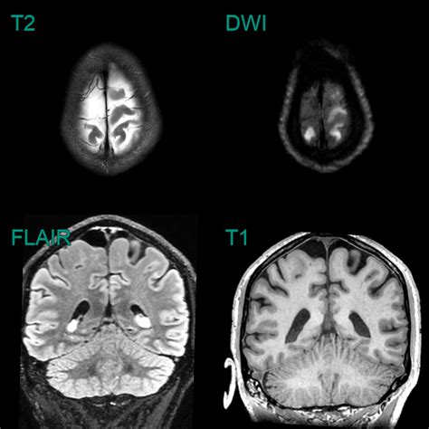 Arachnoid Cyst Neuroradiology