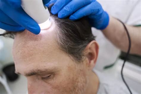 Tipos Síntomas Y Tratamientos Para La Alopecia Dr Günther Rochefort