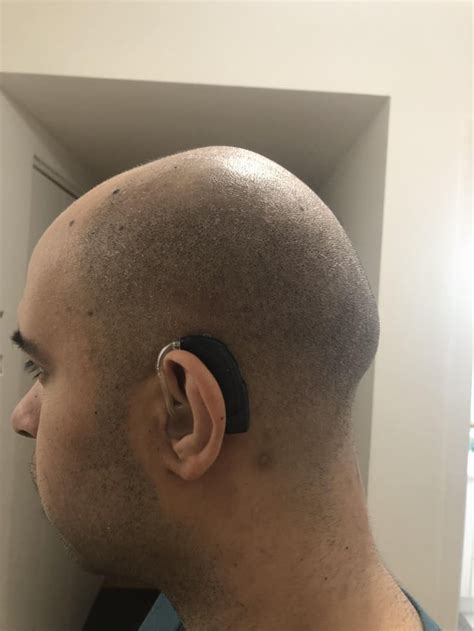 Severe Dryness Redness And Hyperpigmentation Rbald