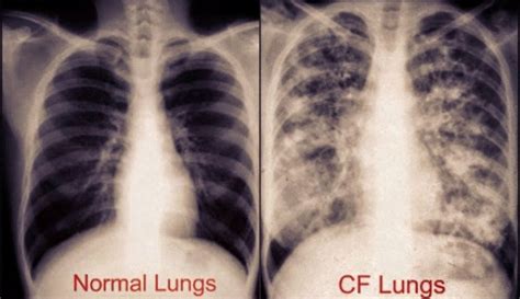 Cystic Fibrosiscf