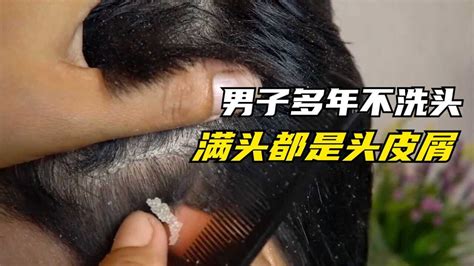 表弟多年不洗头，满头都是头皮屑，清理过程极度解压腾讯视频