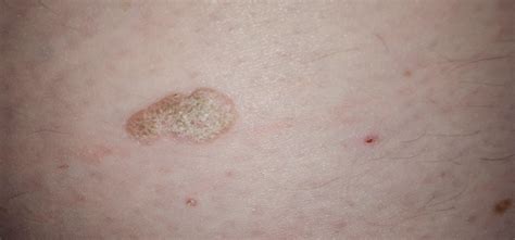 Scaly Patch On Leg That Is Slowly Getting Bigger Does Anyone Know What