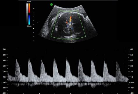 Growth And Doppler Ultrasound Maternal Fetal Medicine