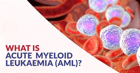 Acute Myeloid Leukaemia CFCH Centre For Clinical Haematology