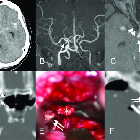 Schematic Illustration Of Our Modification Of Anterior Clinoidectomy