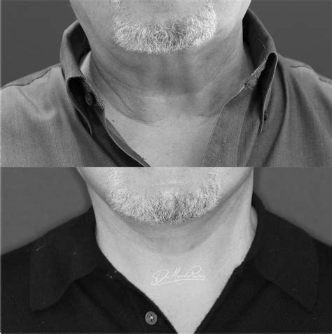 Lifting Facial Resultado Natural Alejandro Ramírez