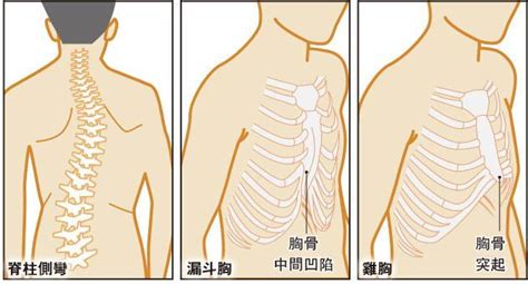 慘變「4個胸」 肋骨外翻作怪？ 肋骨不對稱 提防脊柱側彎 20210118 Beauty And Style 明報 Our Lifestyle