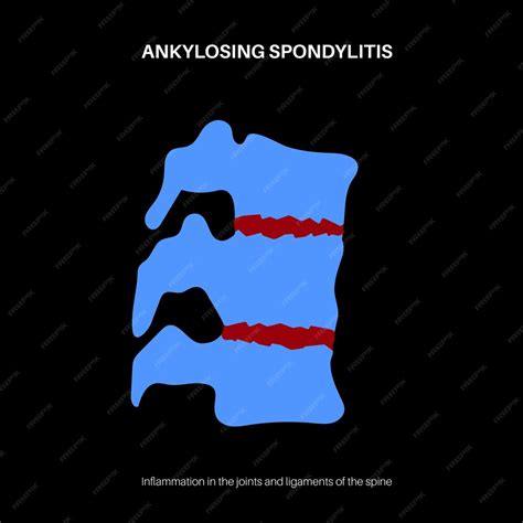 Premium Vector Ankylosing Spondylitis Arthritis That Causes
