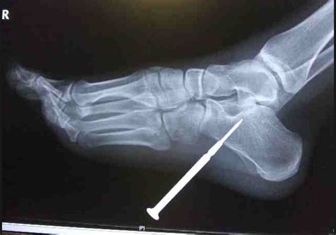 Wound Care Part 3 Puncture Wounds
