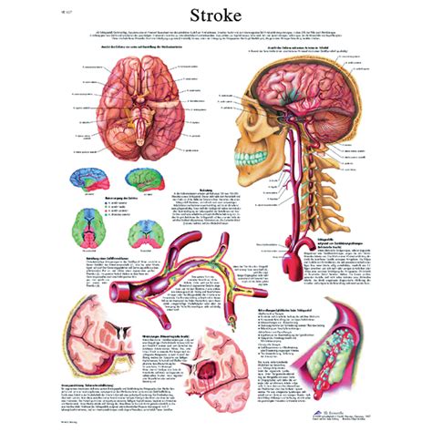 Stroke Chart