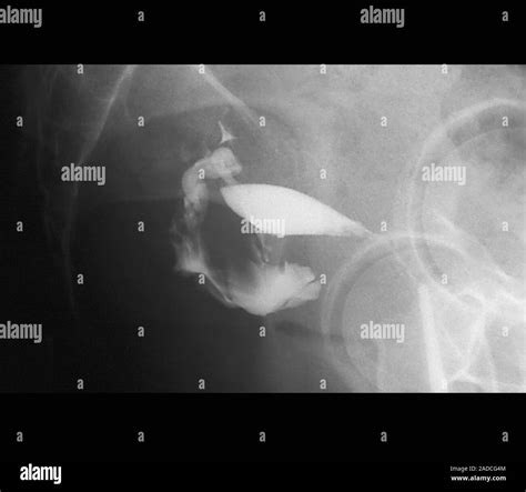 Retroverted Uterus Hystero Salpingogram Contrast Medium X Ray Of The