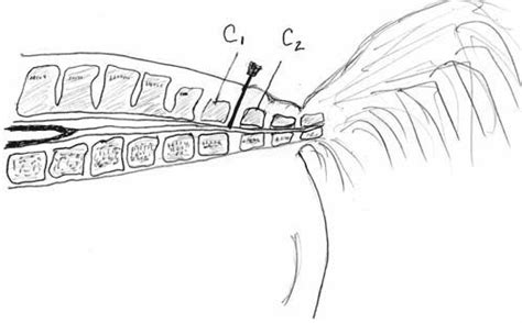 How To Use An Epidural In A Field Situation For Analgesia Or Local