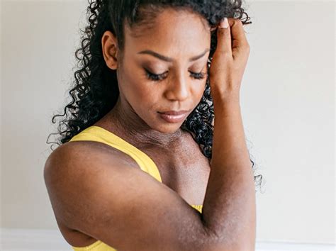 Eczema On Black Skin Pictures Symptoms And Treatment