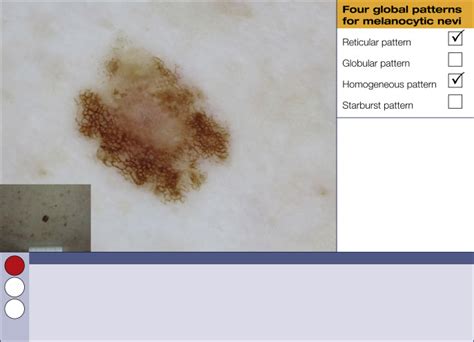 Pattern Analysis Dermoscopic Criteria For Specific Diagnoses Plastic