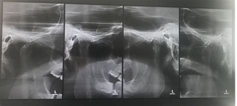턱관절 엑스레이 마모 상태좀 봐주세요 궁금할 땐 아하
