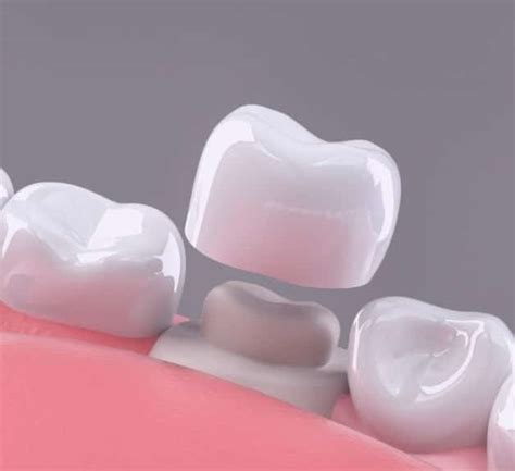 Porcelain Crowns Bridges Inlays And Onlays In Chicago Il Affinity Dental
