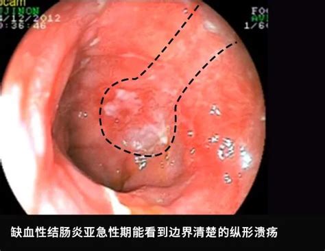 肠镜实拍亲眼看看肠癌是怎么长出来的 丁香医生