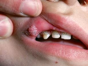Verruca Vulgaris Oral Benign Lumps And Bumps Springerlink