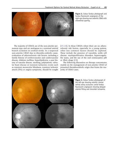 Treatment Options For Central Retinal Artery Occlusion 2012 Pdf