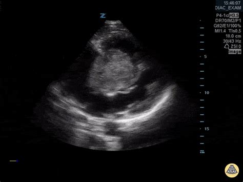 Cardiac Tumors — Tpa