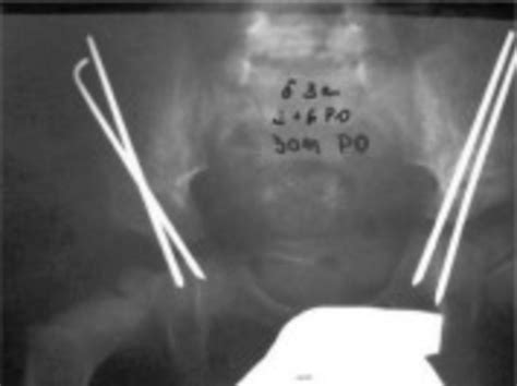 Lateral Radiograph After The Operation Download Scientific Diagram