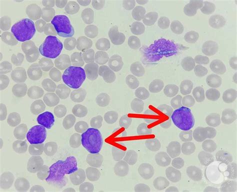 Cup Like Blasts In Aml