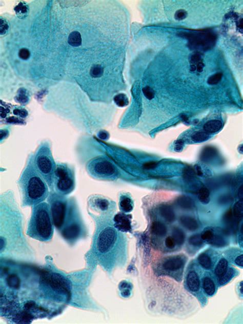 Endocervical Curettage Ecc Incyte Diagnostics