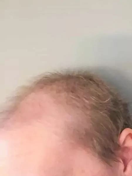 Hair Growth After Chemo Timeline With Monthly Pictures Artofit