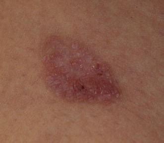 Diagnosis And Treatment Of Lichen Sclerosus Springerlink