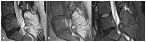 Anatomy And Pathologies Of The Spinous Process