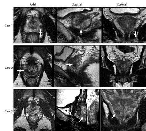 Introduction To Prostate Mri Protocols Hardware T2 Weighted Imaging