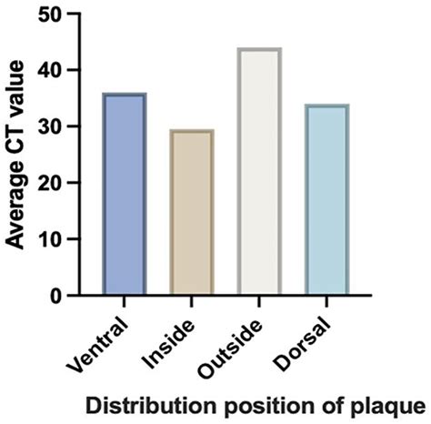 Plaque Distribution Location And Transient Ischemic Attack Vhrm
