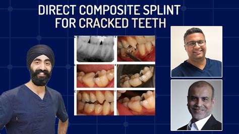 Composite Splint Dental Code At Margaret Burgin Blog