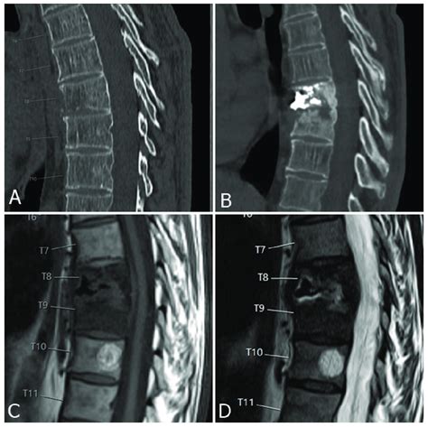 A Ct Scan Of The Thoracic Spine Of A 59 Year Old Man Shows