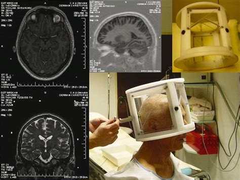 Stereotactic Mri Localizer On The Left Triplanar Mri Images In Download Scientific Diagram