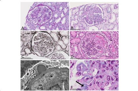 Microscopy A Mesangial With Endocapillary Proliferation Was The Most
