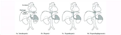 Rcc Caval Thrombus Classification Download Scientific Diagram