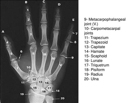 Metacarpal Knuckle Cracking Effects On Cartilage Thickness And Grip