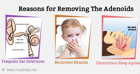 Adenoidectomy Procedure