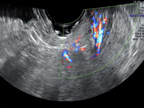 Endometrial Polyp With A Stalk Presenting In The Cervix Looking