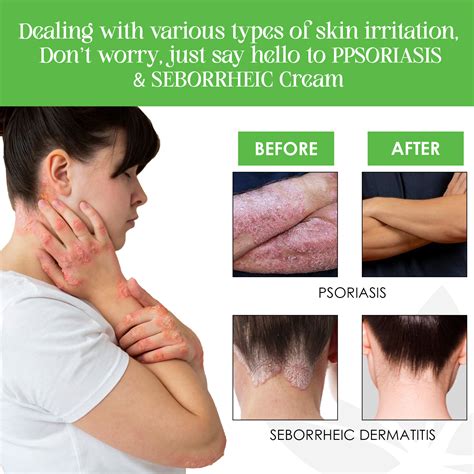 Dermveda Original Advanced Psoriasis And Seborrheic Dermatitis Cream