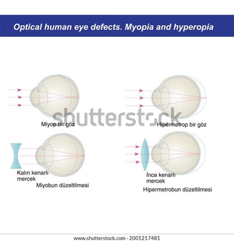 Anatomical Structure Defects Human Eye Human Stock Vector Royalty Free 2001217481 Shutterstock