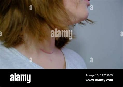 Girls Neck In Motion Close Up Mark On The Neck After Surgery