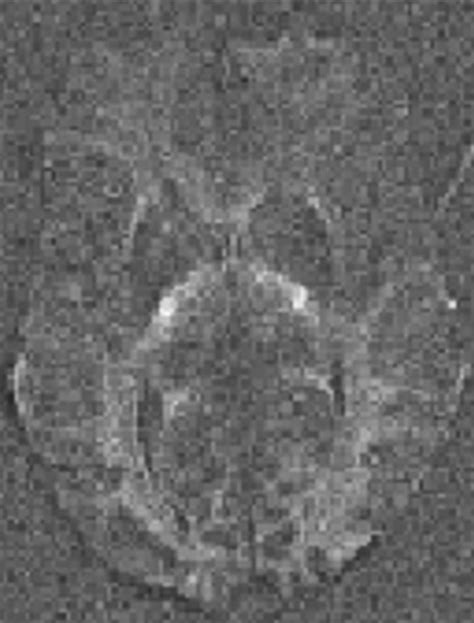 Denoising Micsi