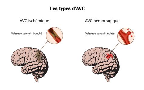 Avc D Finition Sympt Mes Causes Et Cons Quences Cap Retraite