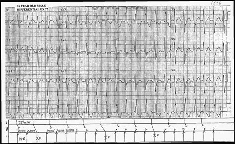 Ecg Interpretation All You Need To Know Manual Of Medicine