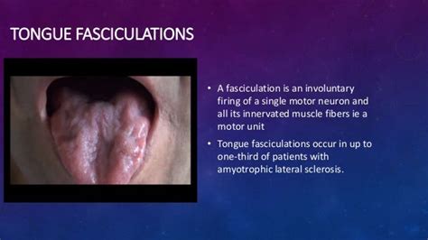 Disorders Of The Hypoglossal Nerves