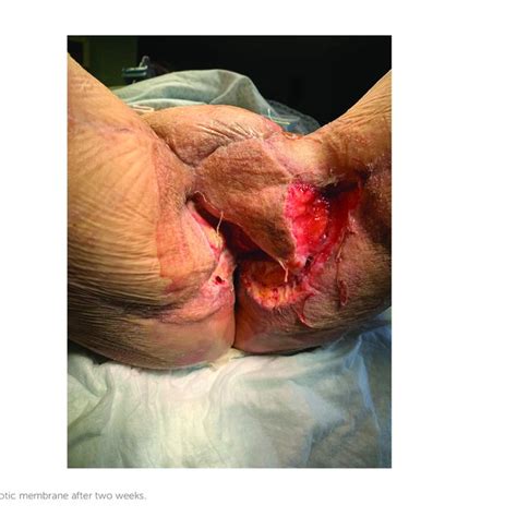 A Human Amniotic Membrane Application B Human Amniotic Membrane Download Scientific